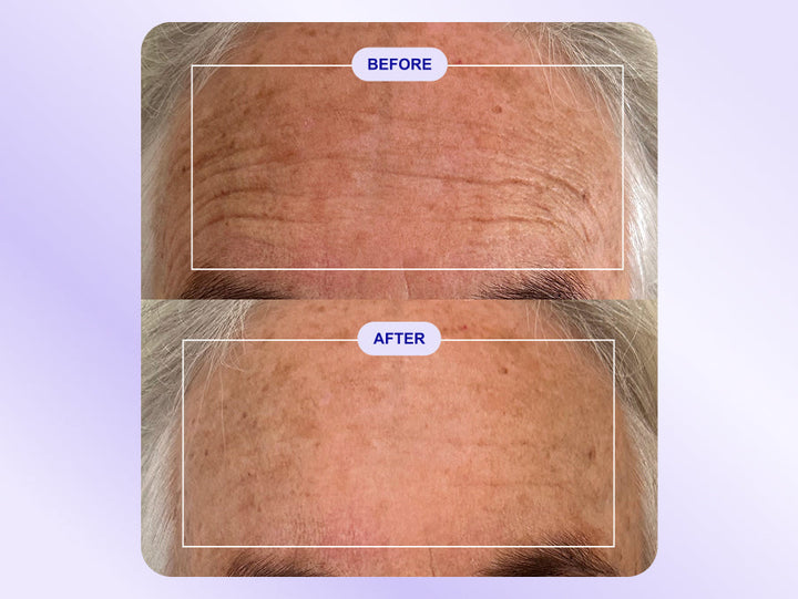 Reusable Silicone Patches for line & wrinkle refinement – Wrinkles ...