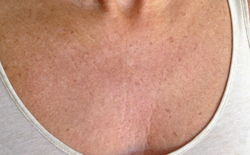 Chest Wrinkle Patch | Smooth Chest, Cleavage and Decolletage Wrinkles ...